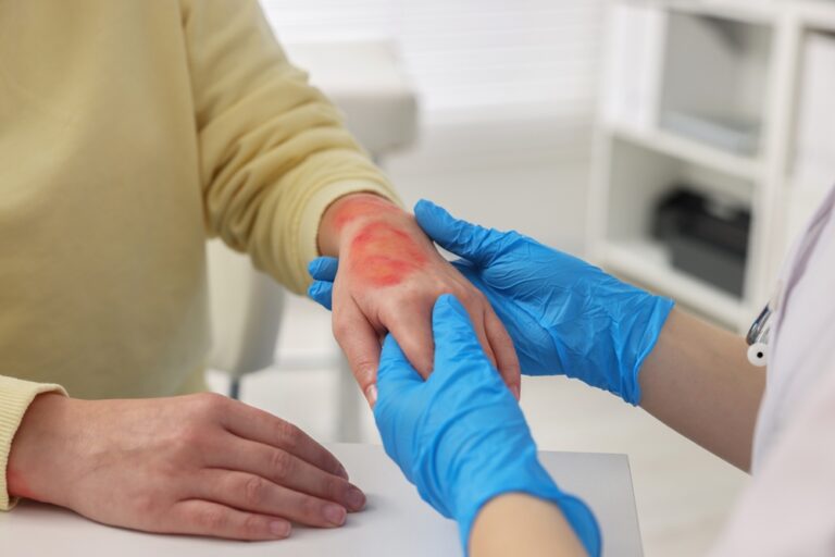 Burn Wound Care Live Oak & San Antonio | Texas MultiSpecialty Clinic